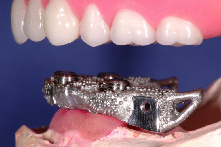 CAD/CAM Implant Bar Design | Titanium Dental Implant Bars | Wiand ...