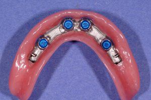 CAD/CAM Implant Bar Design | Titanium Dental Implant Bars | Wiand ...