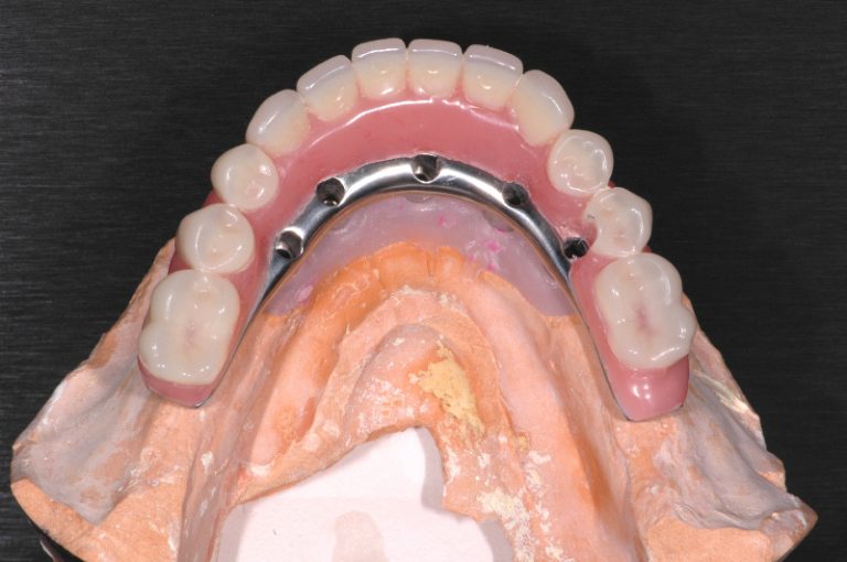 CAD/CAM Implant Bar Design | Titanium Dental Implant Bars | Wiand ...