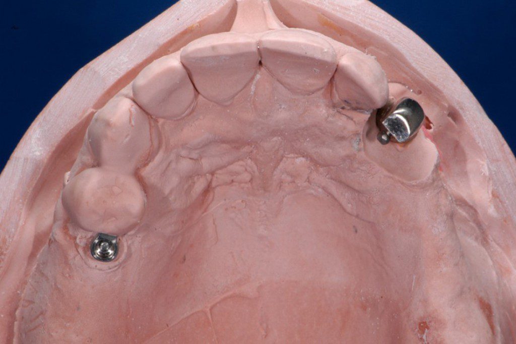 Overdenture Attachment Case Study | Wiand Dental Lab