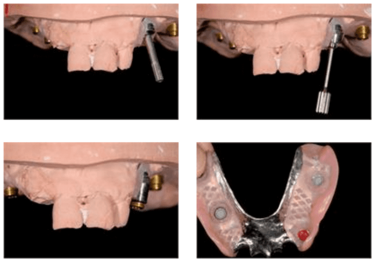 Fixing a Poorly Aligned Implant | Wiand Dental Lab