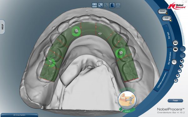 CAD/CAM Implant Bar Design | Titanium Dental Implant Bars | Wiand ...