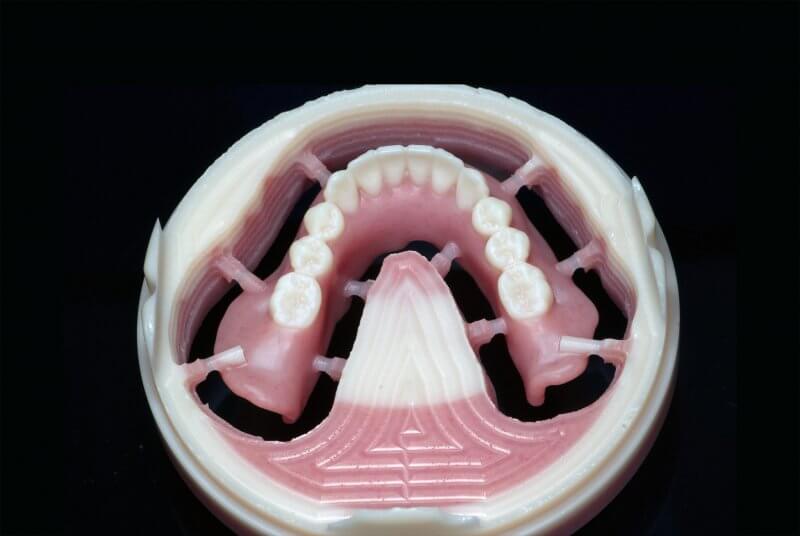 Ivotion Digital Denture System from Ivoclar Vivadent | Wiand Dental Lab