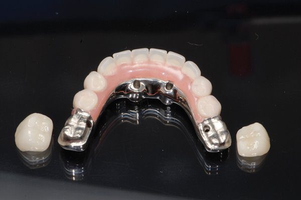 All-on-X Dental Restorative Options | Wiand Dental Lab